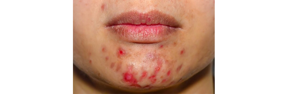 Acne: The ultimate guide - LA Vascular