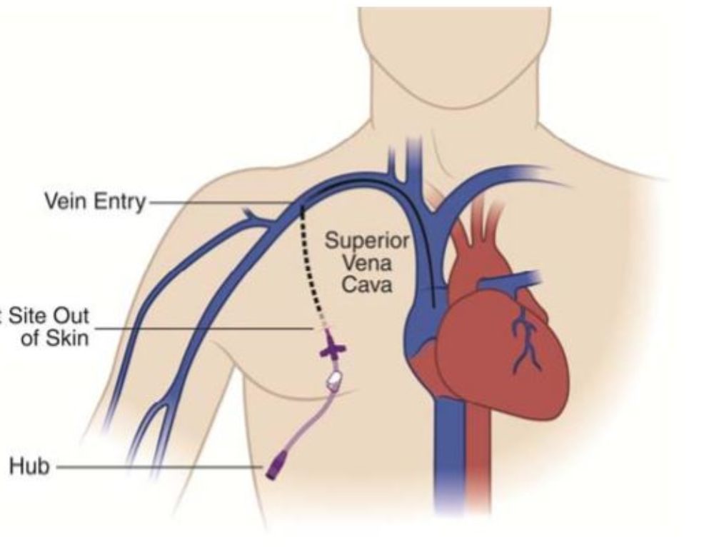 Vascath (Quinton catheter) - LA Vascular