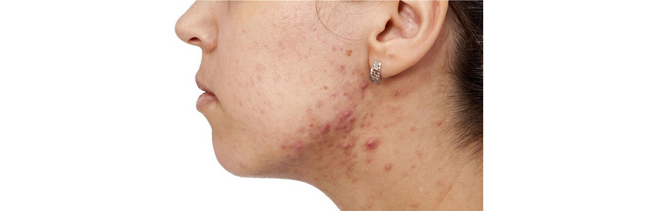 Acne: The ultimate guide - LA Vascular